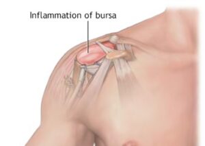 Bursitis - Physio Elements